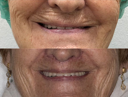 Queiloplastia - Cirugía de Labios en Oviedo - Clínica Estética Rehberger