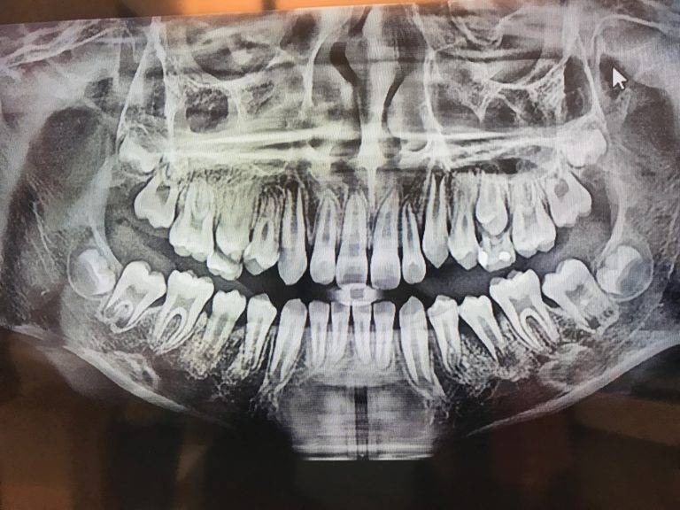 Descubre 7 Alimentos Peligrosos Para Tus Dientes Y Tu Salud Bucodental